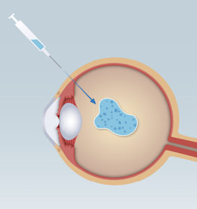 Injektionen bei Makuladegeneration - SehZentrum-Augenheilkunde
